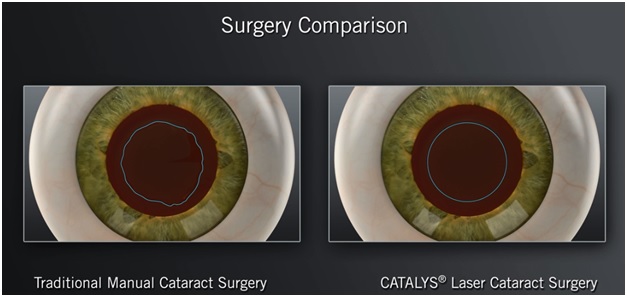 Cataracts Baton Rouge | Laser Cataract Surgery LA | Williamson Eye