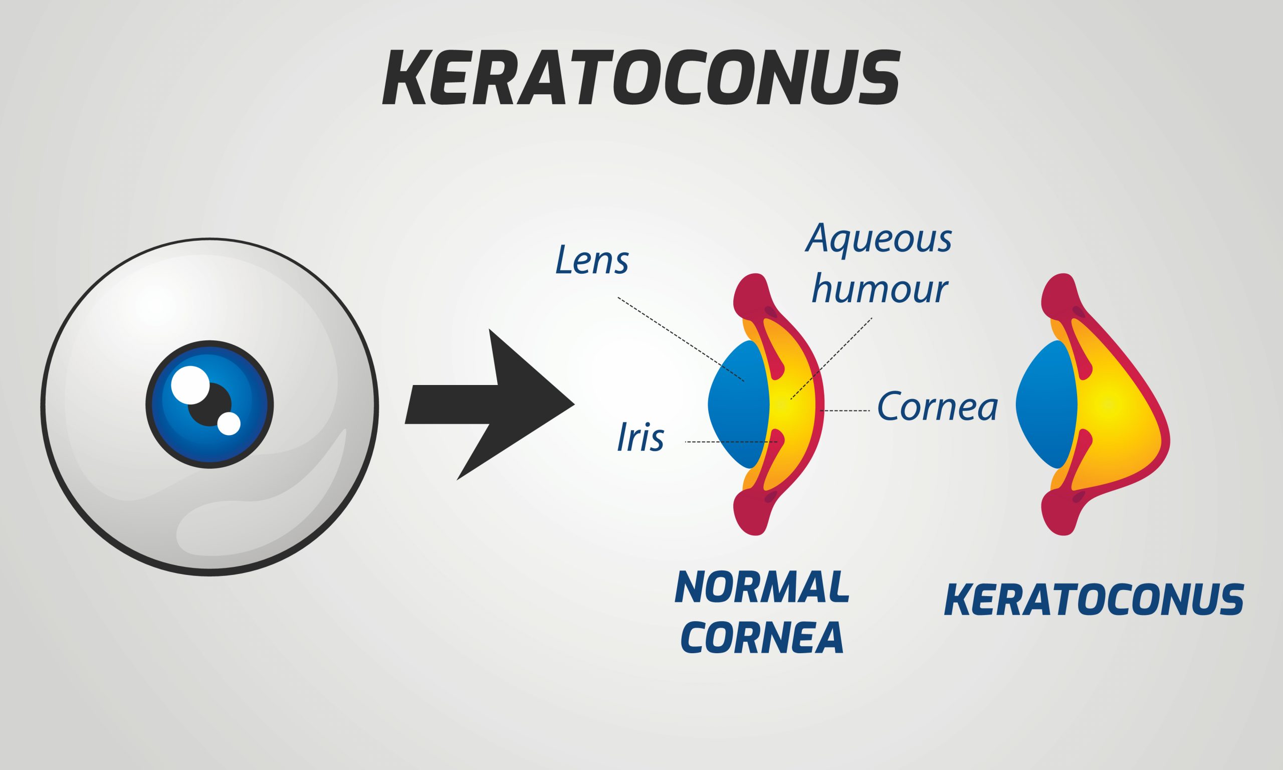 Keratoconus Diagram