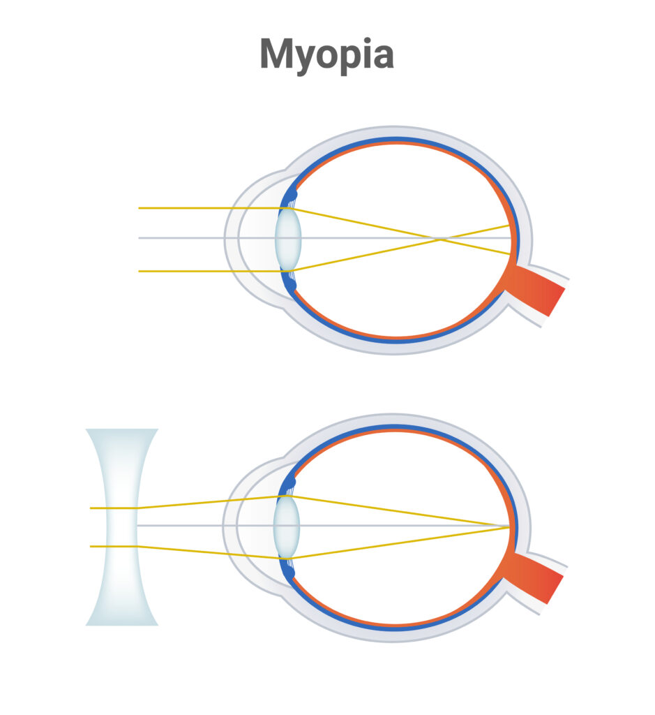 Does Myopia Treatment Work? | Williamson Eye Center